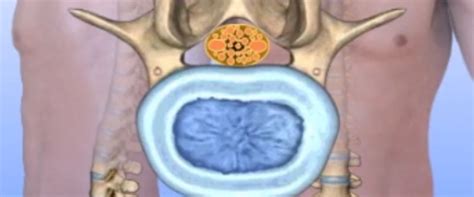 Understanding Spinal Stenosis And Its Causes