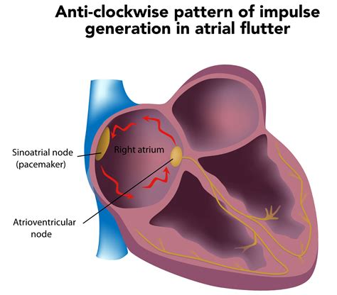 Topic Atrial Flutter Arrhythmia Interpretation Certification Course
