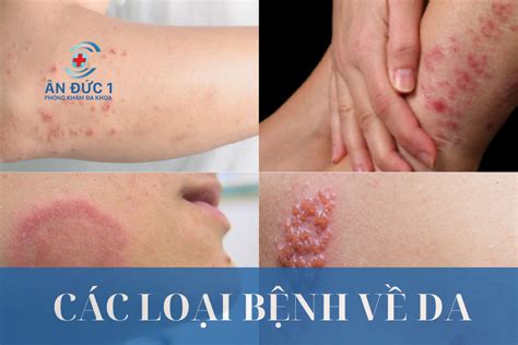 CÁC BỆNH NGOÀI DA VÀO MÙA HÈ Đa Khoa Ân Đức