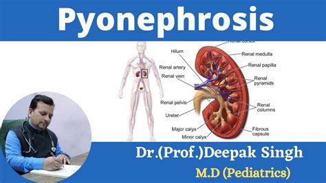 Pyonephrosis Renal Abscess Deepak Pd Singh Youtube