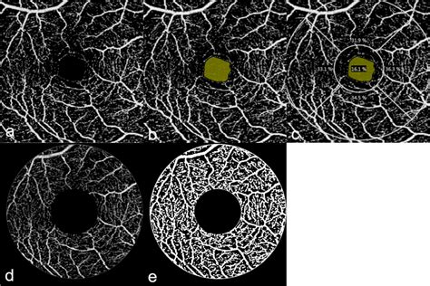Evaluation Of The Macular Perfusion Density Pd The Image Of The