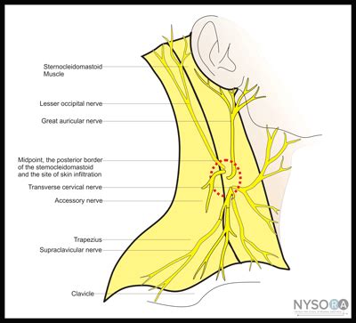 Cervical Plexus Block NYSORA The New York Babe Of Regional Anesthesia