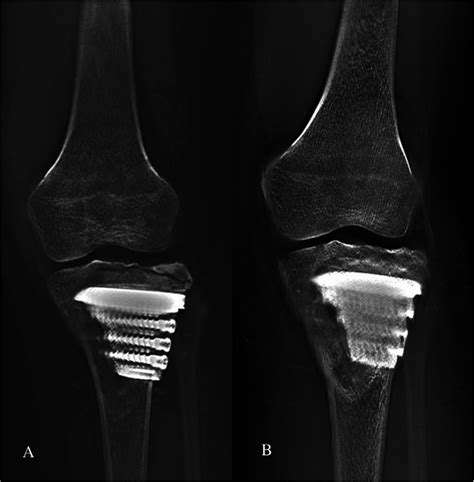 Three Dimensional Printed Porous Implant Combined With Autograft Reconstruction For Giant Cell
