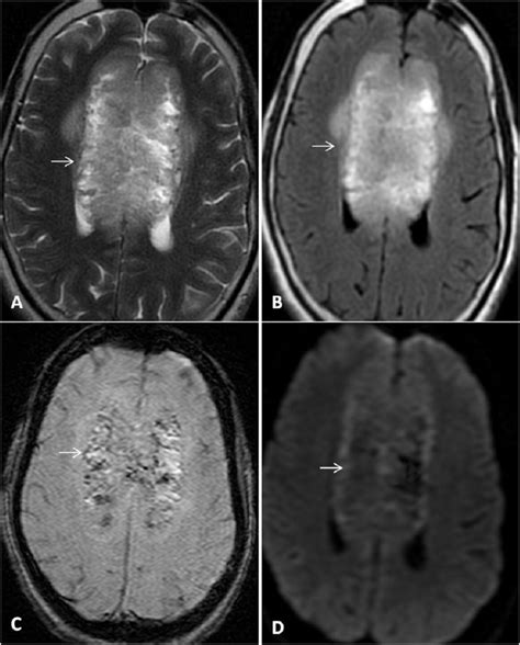 Classical Imaging Finding In Callosal Glioblastoma Multiforme Bmj