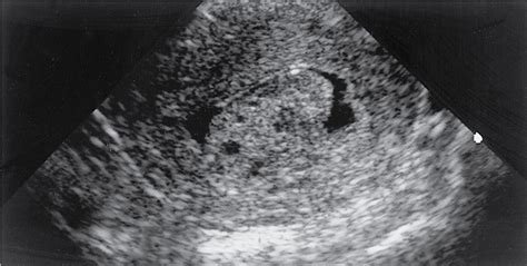 Endometrialjunctional Zone Thickening Radiology Key