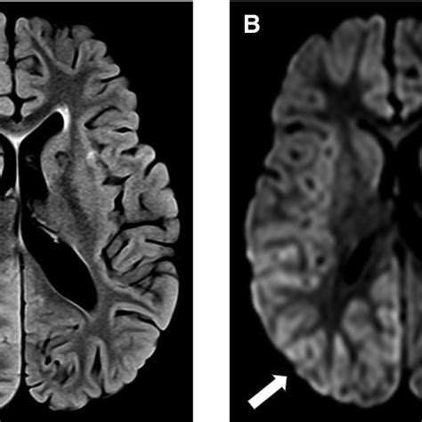 ASL Perfusion Map Performed The Day Following Admission A Reveals Download Scientific