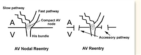 Diagrammatic Of The Two Pathways Theme Common To AVNRT And AVRT Download Scientific Diagram