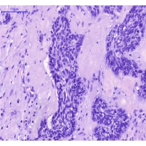Year Old Man With Cholangiocarcinoma Bismuth Type Iv And Right Portal Download Scientific