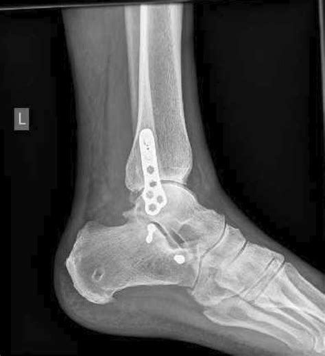 Emergency Definitive Management Of A Subtalar Dislocation With An