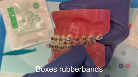 Rubber Bands Stuck In Braces At Steven Martines Blog