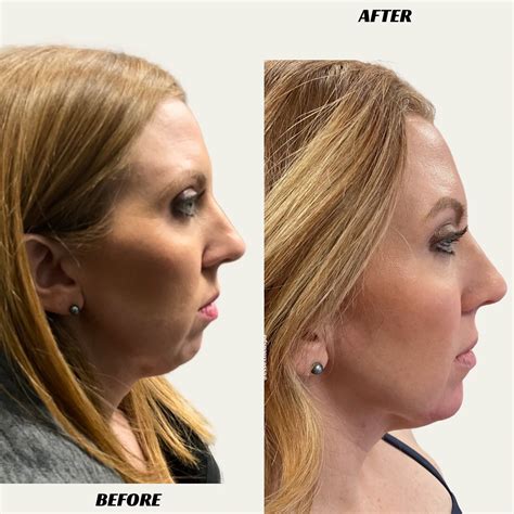 Essex Medspa Essexmedspa • Instagram Photos And Videos