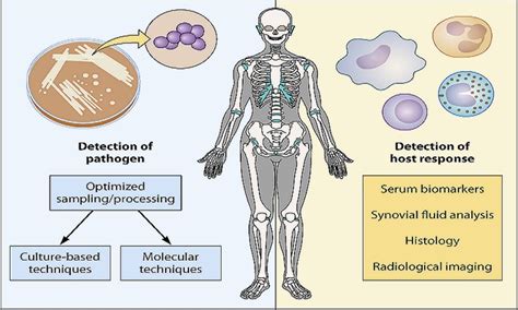 Prosthetic Infection