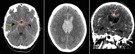 Ruptured Pericallosal Aneurysm With Subarachnoid Haemorrhage Ct