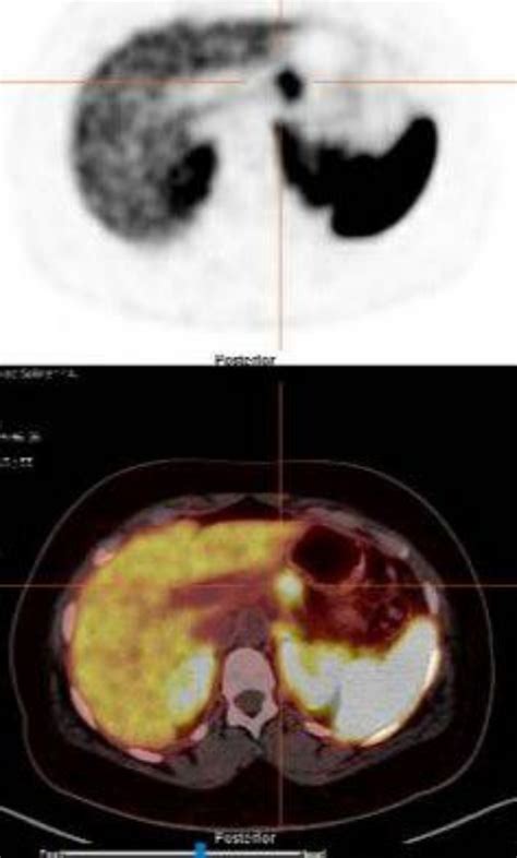 Robotic Spleen Preserving Distal Pancreatectomy The Warshaw And Kimura Techniques