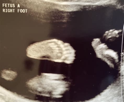 Weeks Pregnant With Twins Development And Care The Way It Really Is