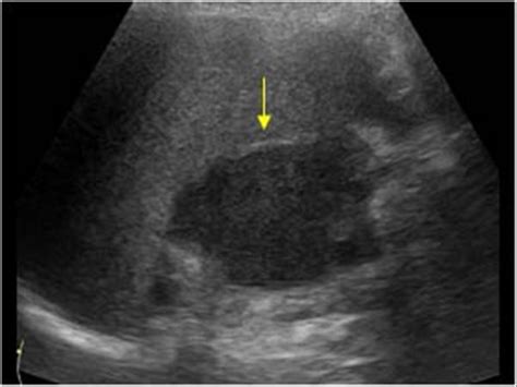 Pancreas Pathology Flashcards Quizlet