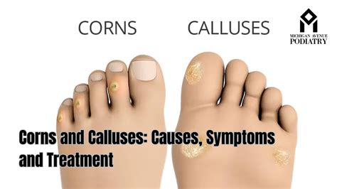 Corns And Calluses Causes Symptoms And Treatment