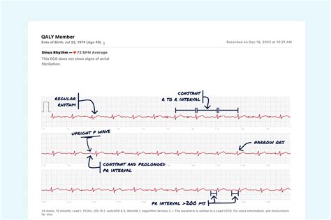 Junctional Rhythm Vs First Degree Av Block On Your Watch Ecg Qaly