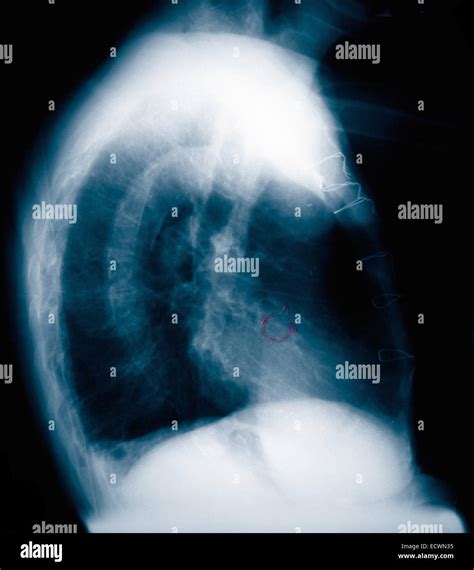 Pneumonia Lateral Chest X Ray Imaging In Pediatric Pneumonia