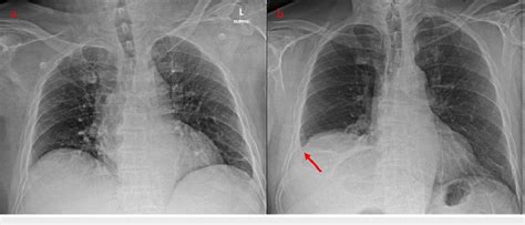 Supine Anteroposterior Cxr Of Case 1 Taken Three Years Before Admission Download Scientific