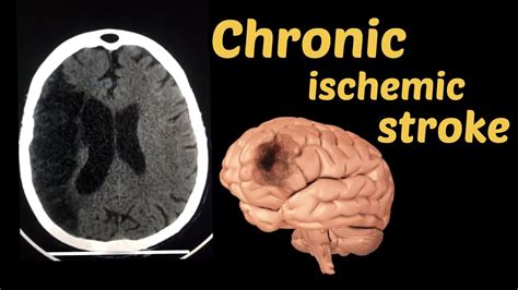 Mca Territory Chronic Ischemic Infarct Ct Brain Radiology Stroke