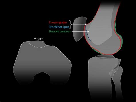 Trochlear Dysplasia Of Femur Bone And Spine