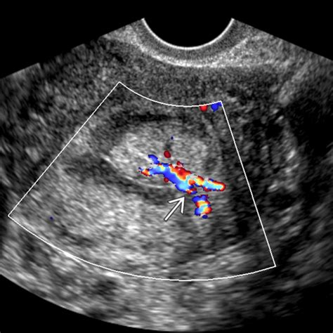 Endometrial Polyp Radiology Key