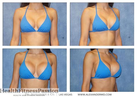 Gummy Bear Implants A Comprehensive Guide