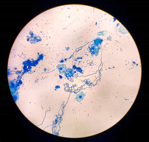 60 Infección De Streptococcus Fotos Fotografías De Stock Fotos E Imágenes Libres De Derechos