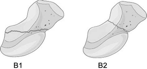 The Herbert Classification Of Middle Third Fractures B1 Distal Oblique