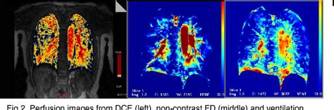 Figure 1 From Clinical Implementation Of Fourier Decomposition At 3 T Semantic Scholar