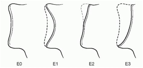 Management Of Bone Loss In Primary Reverse Shoulder Arthroplasty