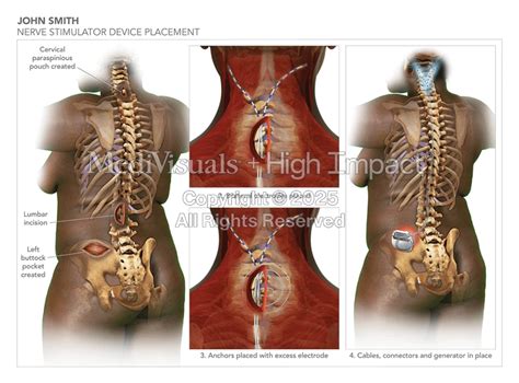 Nerve Stimulator Device Placement Medivisuals High Impact