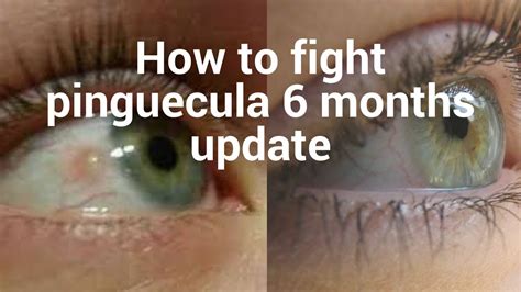 How To Fight Pinguecula Update For 6 Months Youtube