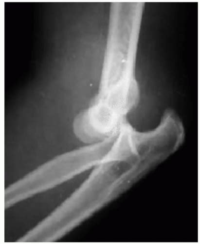 Ultrasound Guided Brachial Plexus Block Retroclavicular Approach Anesthesia Key
