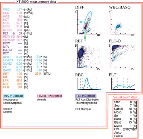 Sindrome Mielodisplastica Mds Raeb 2 Ematologia In Fluorescenza