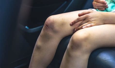 Why Do I Have A Bump On My Forehead