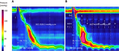 Diffuse Esophageal Spasm