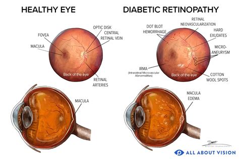 Diabetic Retinopathy Vision Looks Like