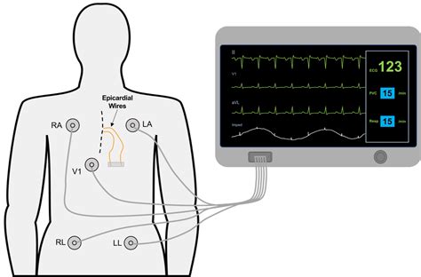 Display Of The Surface And Atrial Electrogram Atrial Electrogram