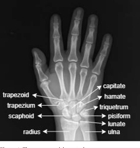 Fracture Detection In Wrist X Ray Images Using Deep Learning Based Object Detection Models