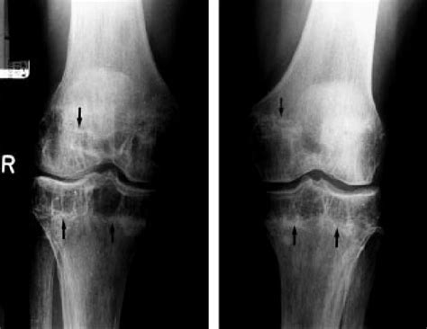 Radiographic Examination Of Both Knees The Osteoporotic Areas In The