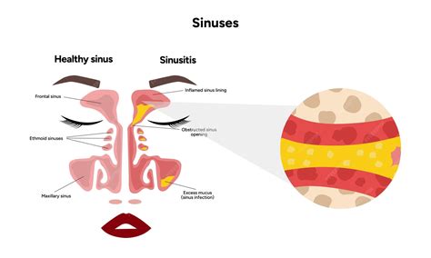 Anatomie Des Sinus Sinusite De Lanatomie Nasale Inflammation De La