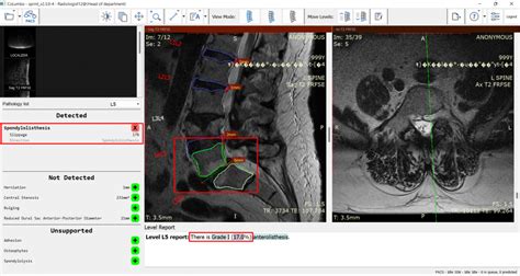 Listhesis Percentage And Grade Columbo