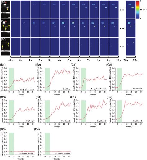 Spatiotemporal Characterization Of Hemodynamic Ioss A Enlarged