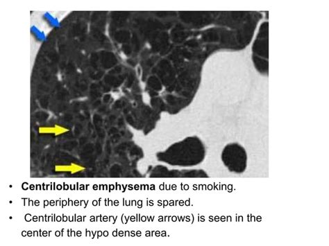 Hrct Lung Basic Interpretation Ppt Lung And Respiratory Health Diseases And Conditions