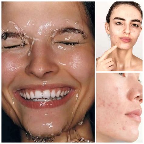 A Simple Step Skincare Routine For Acne Prone Skin