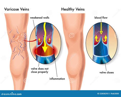 Varicose Veins Line Icon Venous Circulation Varicose Veins Outline
