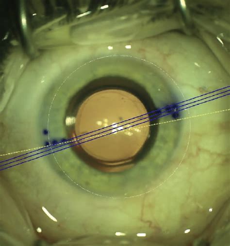 CRSTG Europe Edition Early Experience With The RayOne EMV Toric IOL