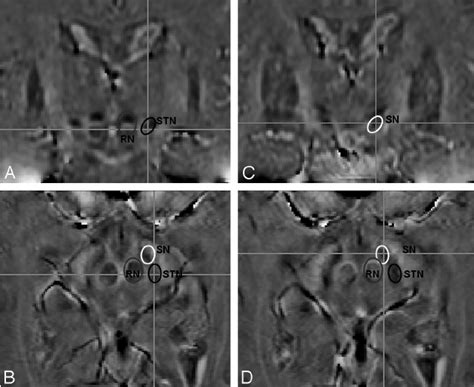 3d Axial Swi Phase Images Were Obtained With Isotropic Voxels Te ϭ 20